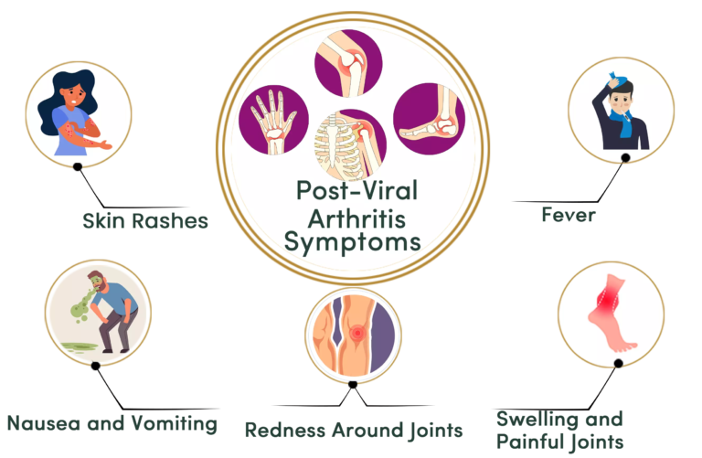 Post Viral Arthritis Treatment - Durja Ayurveda